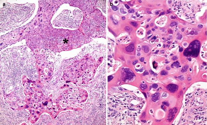 Squamous Cell Carcinoma of the Cervix | Obgyn Key