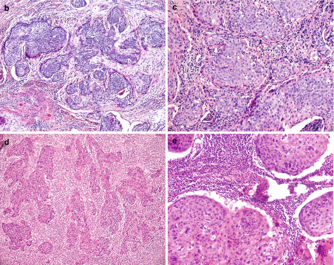 Squamous Cell Carcinoma of the Cervix | Obgyn Key