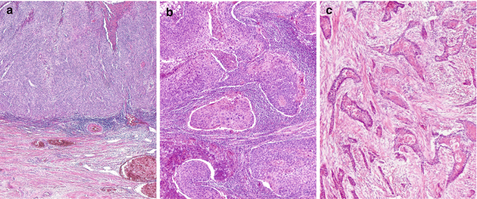 Squamous Cell Carcinoma of the Cervix | Obgyn Key