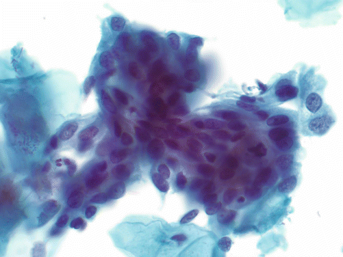 Endocervical Adenocarcinoma In Situ/Cervical Glandular Intraepithelial ...