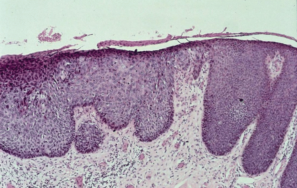 Vulval Intraepithelial Neoplasia | Obgyn Key