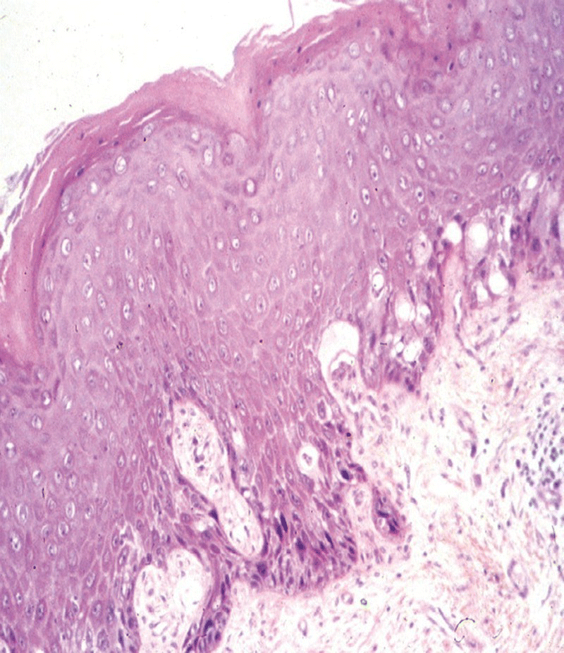 Vulval Intraepithelial Neoplasia | Obgyn Key