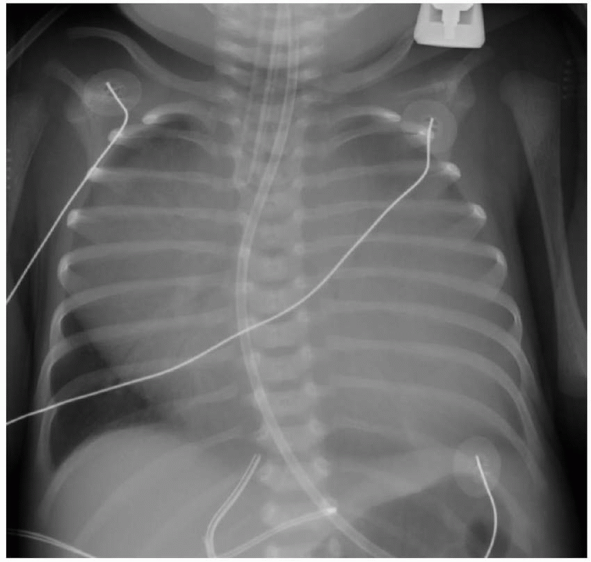 Pediatric Cardiac Radiology | Obgyn Key