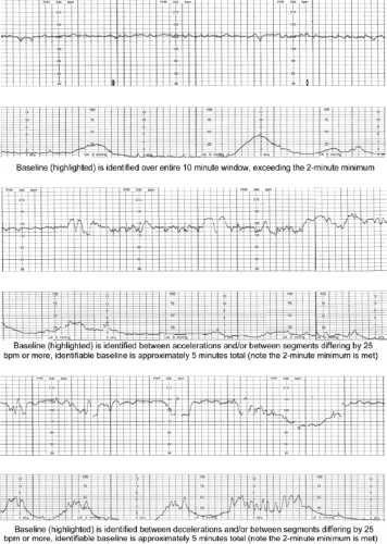 Intrapartum Electronic Fetal Monitoring | Obgyn Key