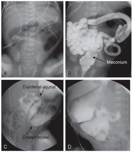 Intestinal Atresia | Obgyn Key