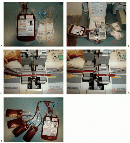 Transfusion of Blood and Blood Products | Obgyn Key