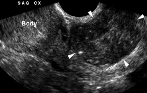 Myometrium | Obgyn Key