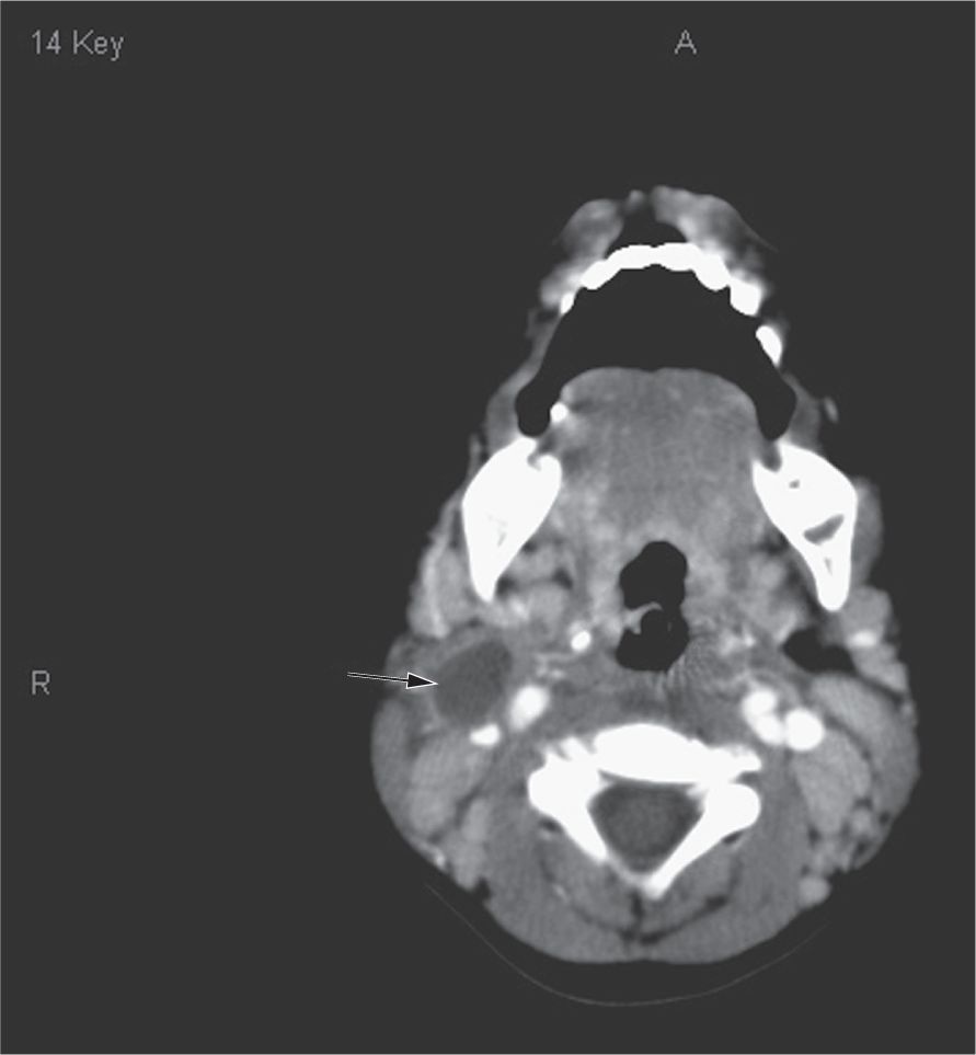 Neck Swelling | Obgyn Key