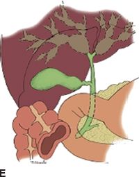 Choledochal Cyst | Oncohema Key