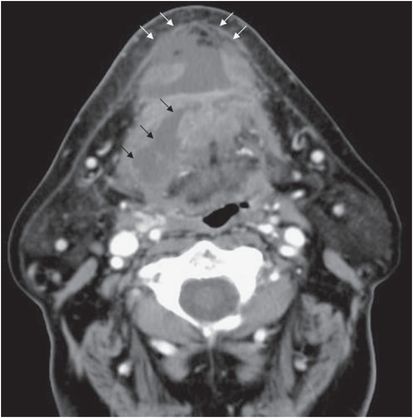 Dental infection and its consequences | Oncohema Key