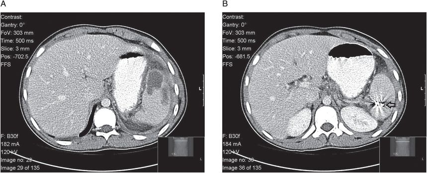 Splenic abscess | Oncohema Key