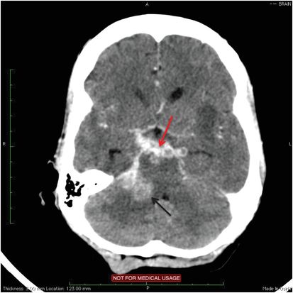 Immune reconstitution inflammatory syndrome (IRIS) | Oncohema Key