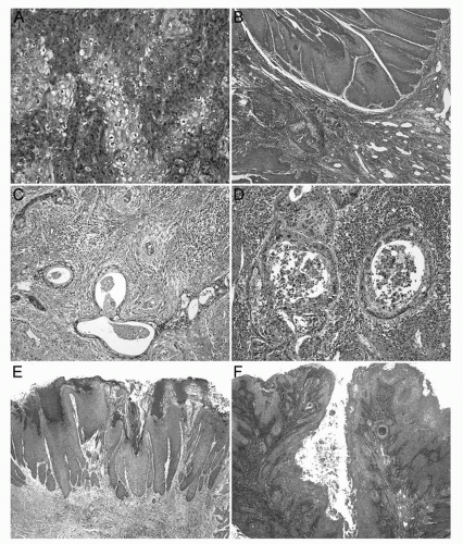 Diagnosis, Epidemiology, and Pathology of Penile Cancer | Oncohema Key