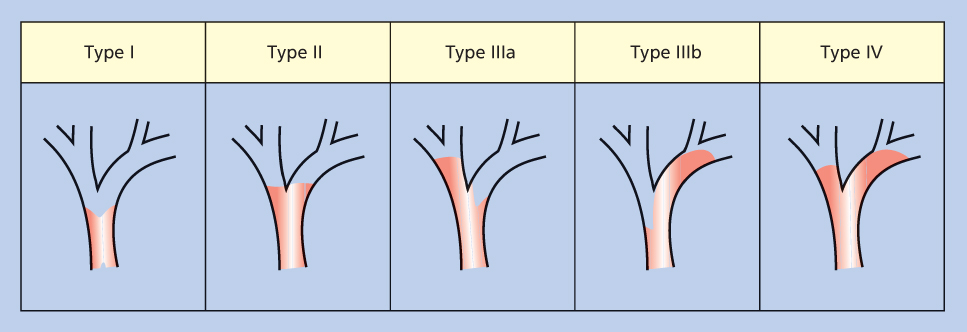 Gallbladder and bile duct cancer | Oncohema Key