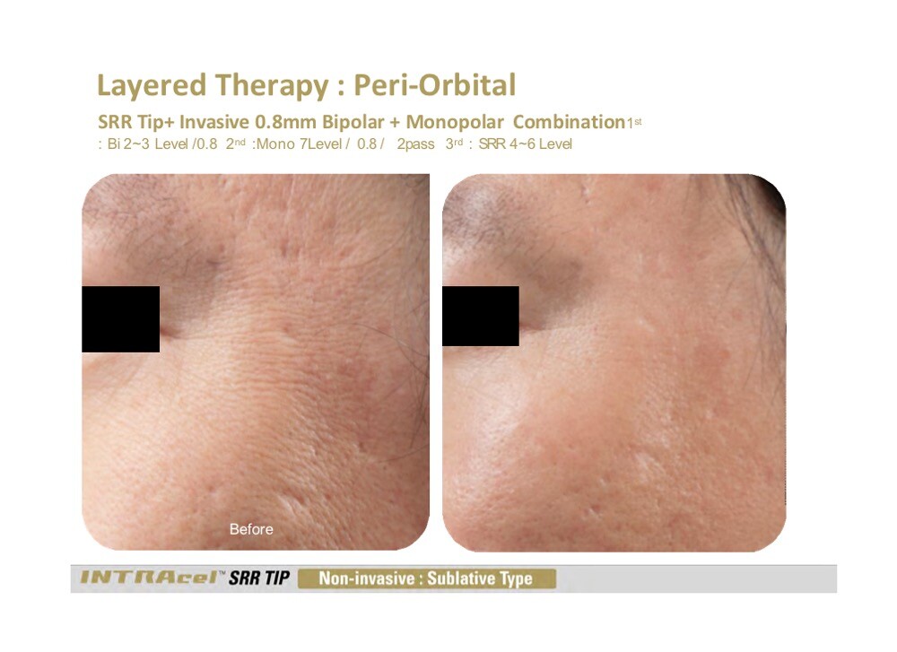 INTRAcel™ Before and After Treatment Images | Perigee Medical
