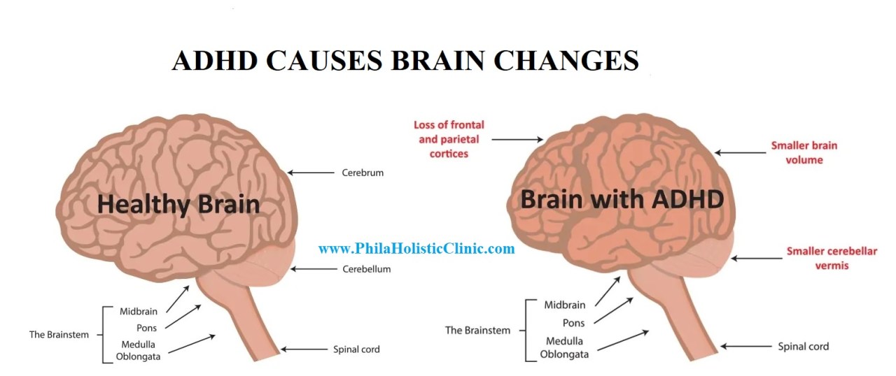 Adhd Brain Structure Adhd Brain Structure