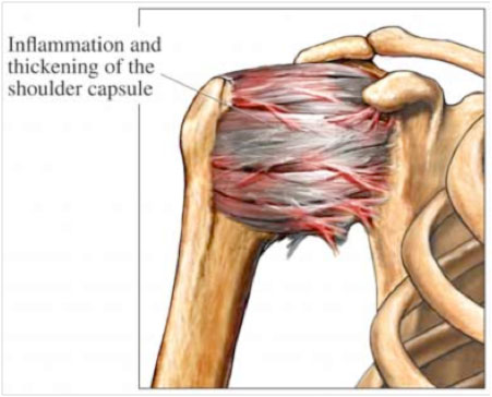 Frozen Shoulder | PHYSIOCURE