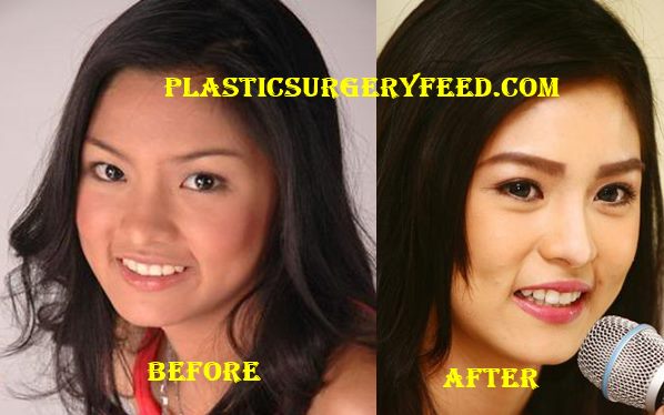 Kim Chiu Plastic Surgery - Plastic Surgery Feed