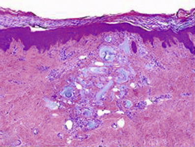 Dermatopathology | Plastic Surgery Key