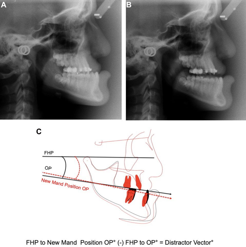 Cleft Lip and Palate | Plastic Surgery Key