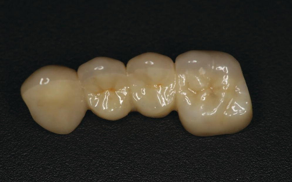 11: Ceramic Materials in Implant Dentistry | Pocket Dentistry