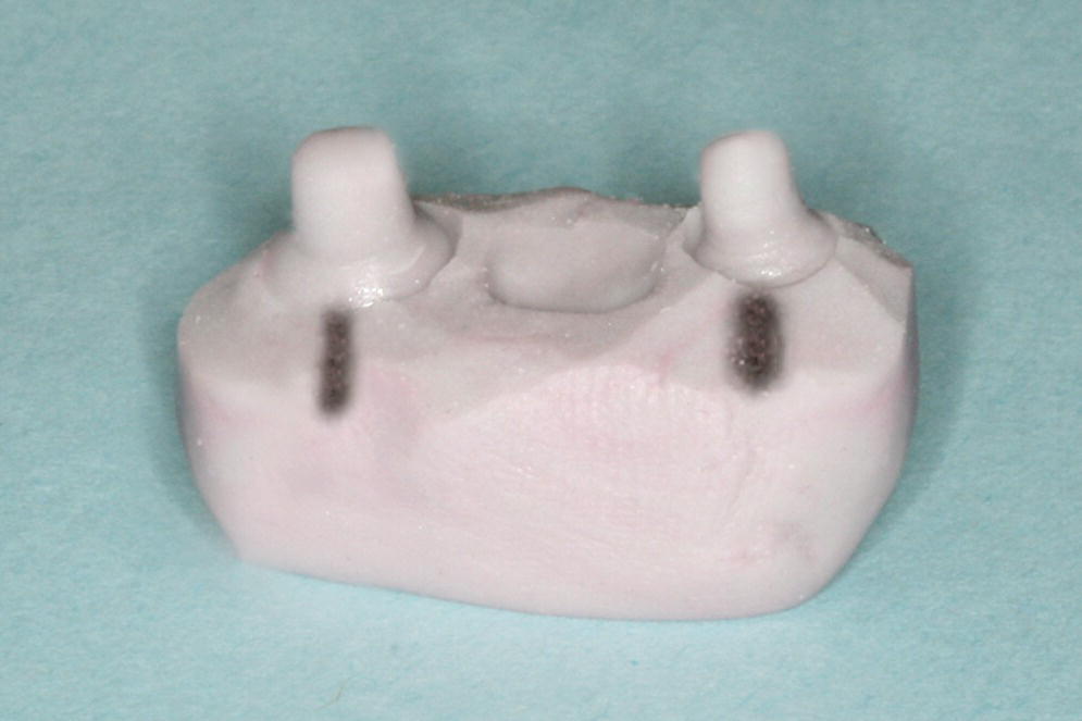 14: Occlusion: The Role in Implant Prosthodontics | Pocket Dentistry