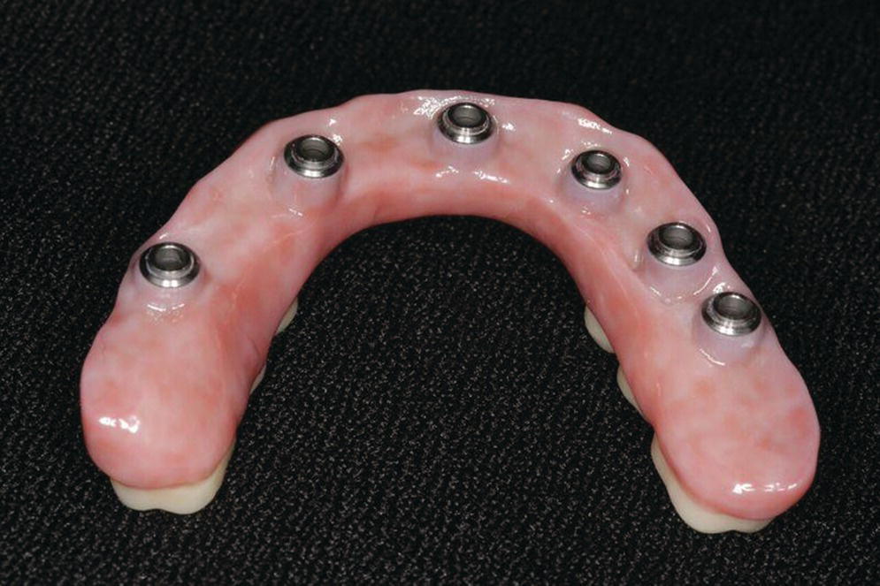 20: Digital Alternatives in the Implant Restoration of the Edentulous ...