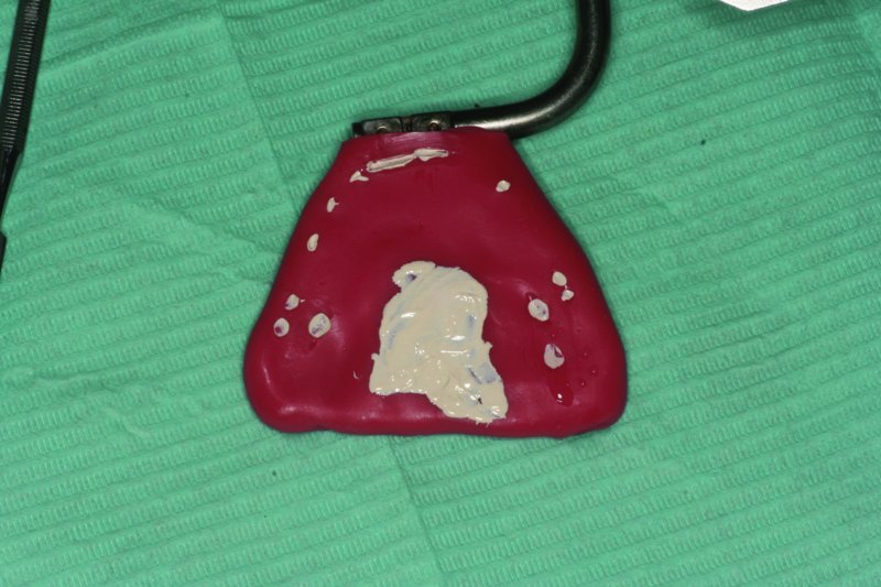 Facebows: The Facebow Recording | Pocket Dentistry