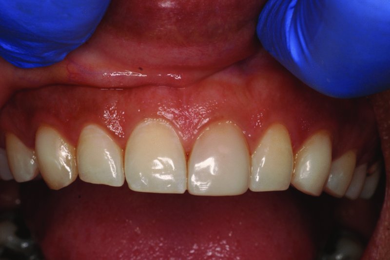 Anterior Freehand Direct Restoration | Pocket Dentistry