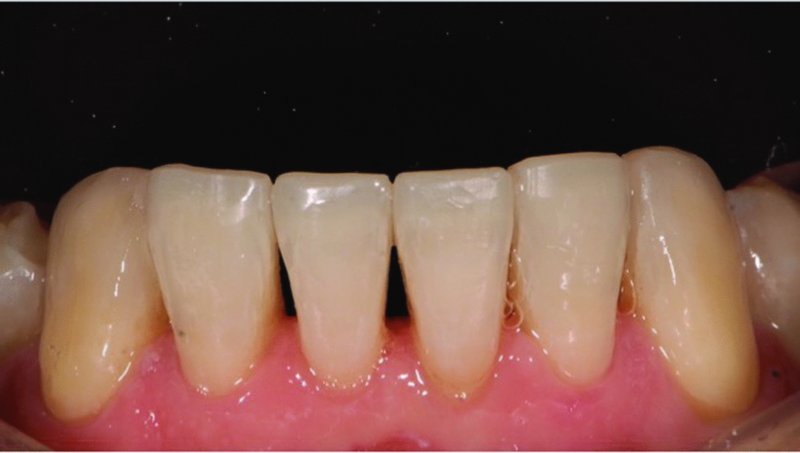 Mandibular Anterior Direct Build-up: Injection Moulding Technique ...