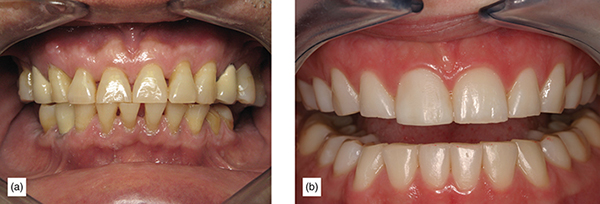 The Importance of Occlusion and Occlusal Diagnosis in Restorative ...