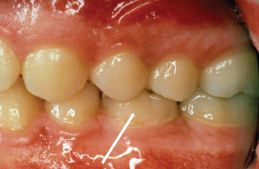 Spacing of teeth | Pocket Dentistry