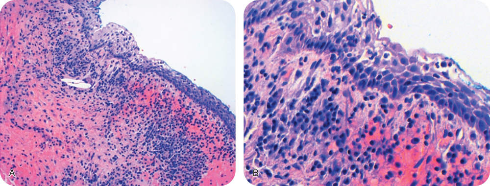 Periapical Surgery Case II: Apical Infection Spreading to Adjacent ...