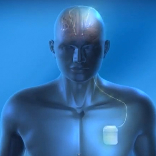 Alzheimer's Disease Will Be Treated Using First Brain Pacemaker ...