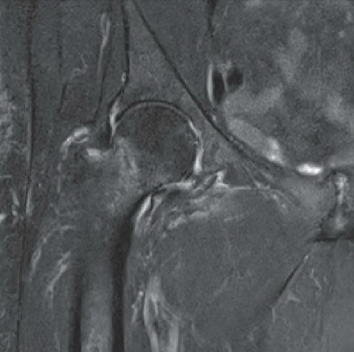 Radio-Occult Hip Fracture | Radiology Key