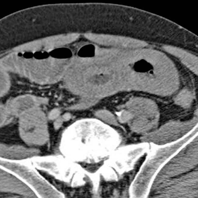 Mesenteric and Small Bowel Trauma | Radiology Key