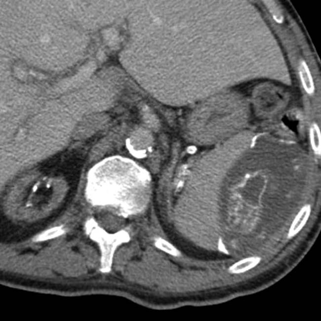 Splenic Cyst | Radiology Key