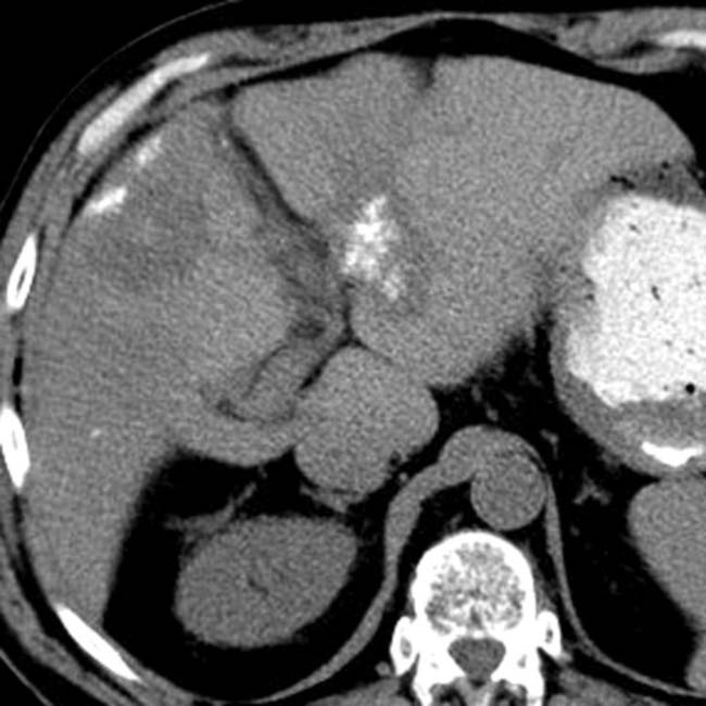 Hepatic Metastases and Lymphoma | Radiology Key