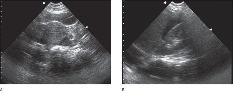 First Trimester Pregnancy | Radiology Key