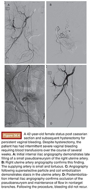 Postpartum Hemorrhage | Radiology Key