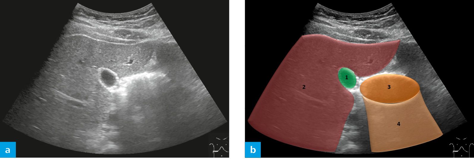 Gallbladder | Radiology Key