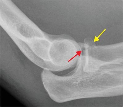 71 22-year-old male with elbow pain after a fall onto outstretched hand ...