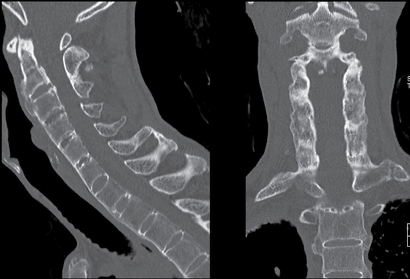 Infectious and Inflammatory Disease of the Spine | Radiology Key