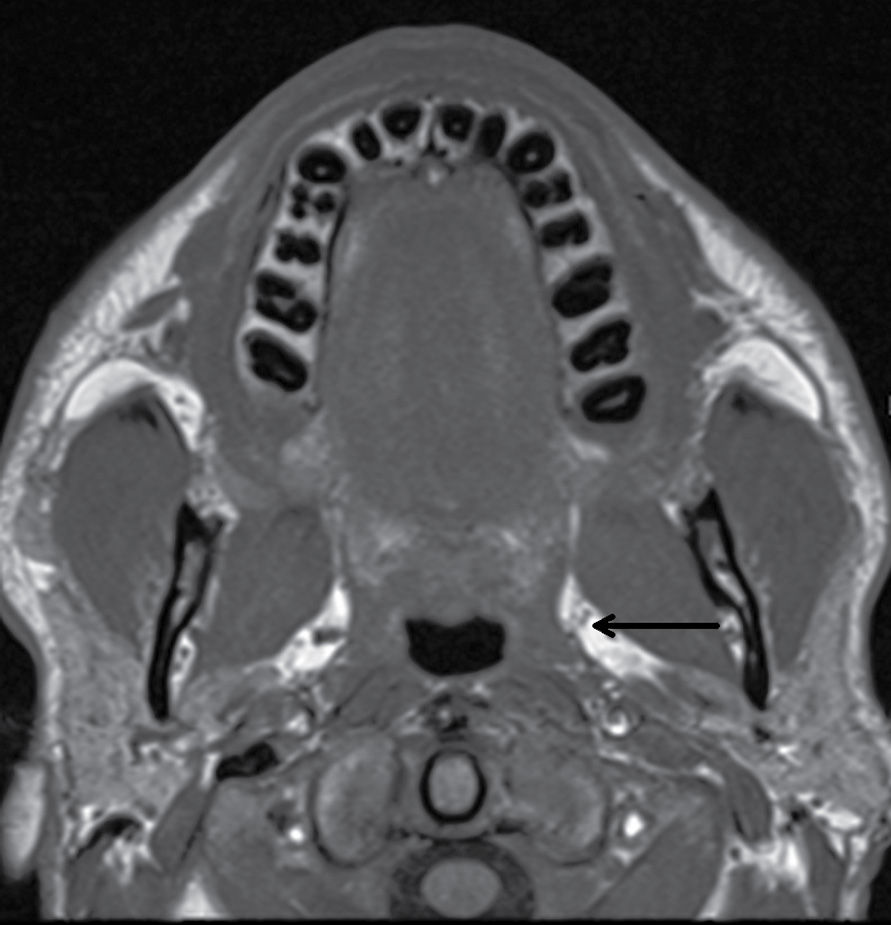 The Acute Neck: Inflammation, Infections, and Trauma | Radiology Key