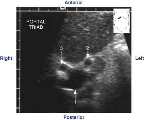 Gallbladder and Biliary Tract Scanning Protocol | Radiology Key