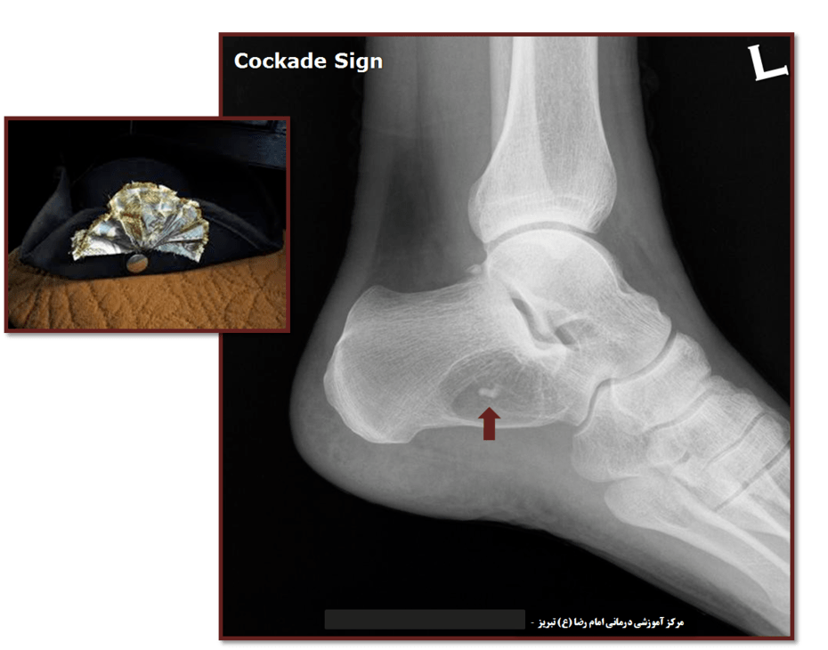Cockade Sign - radRounds Radiology Network