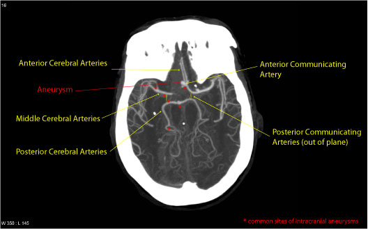 Cerebral Aneurysm Ct