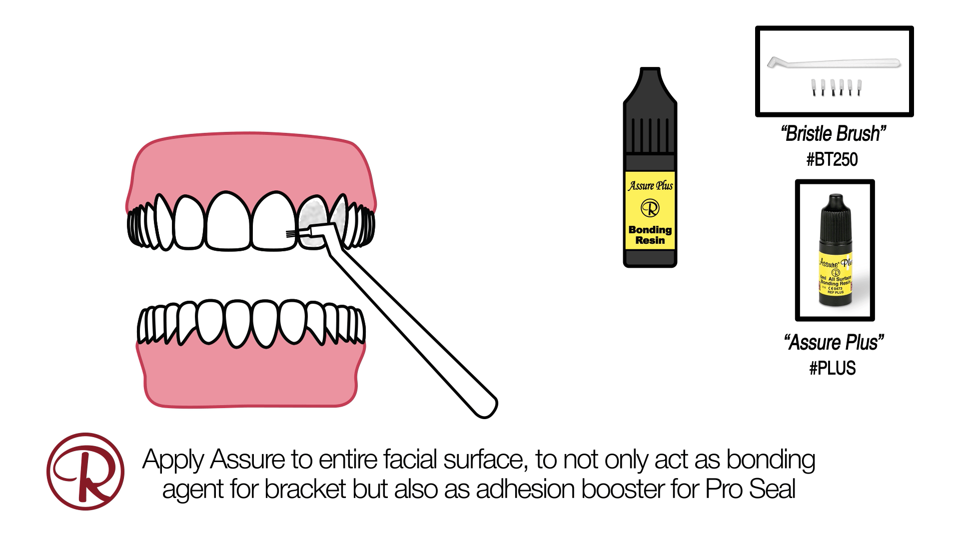 Using Pro Seal to Prevent Decalcified Lesions