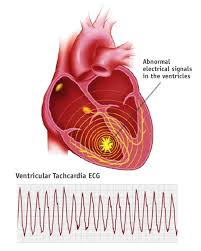 CME 14/04/16 - Tachyarrhythmia Management - Charlie's ED