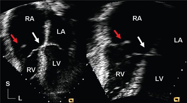Ebstein’s Malformation and Tricuspid Valve Diseases | Thoracic Key